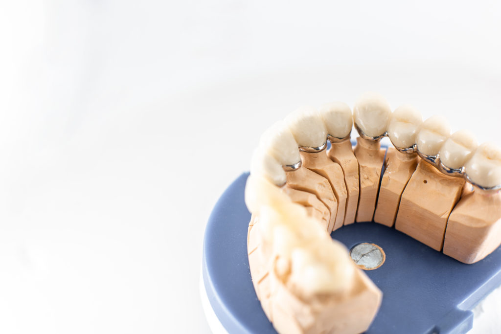 Dental Crowns in the City of London | German Dental Clinic